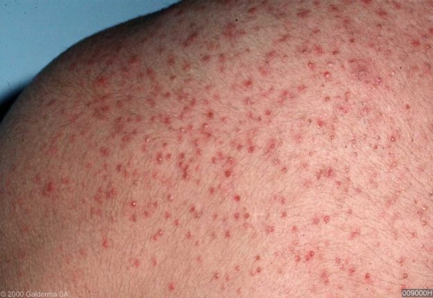 acne from anabolic steroids - Steroidal.com